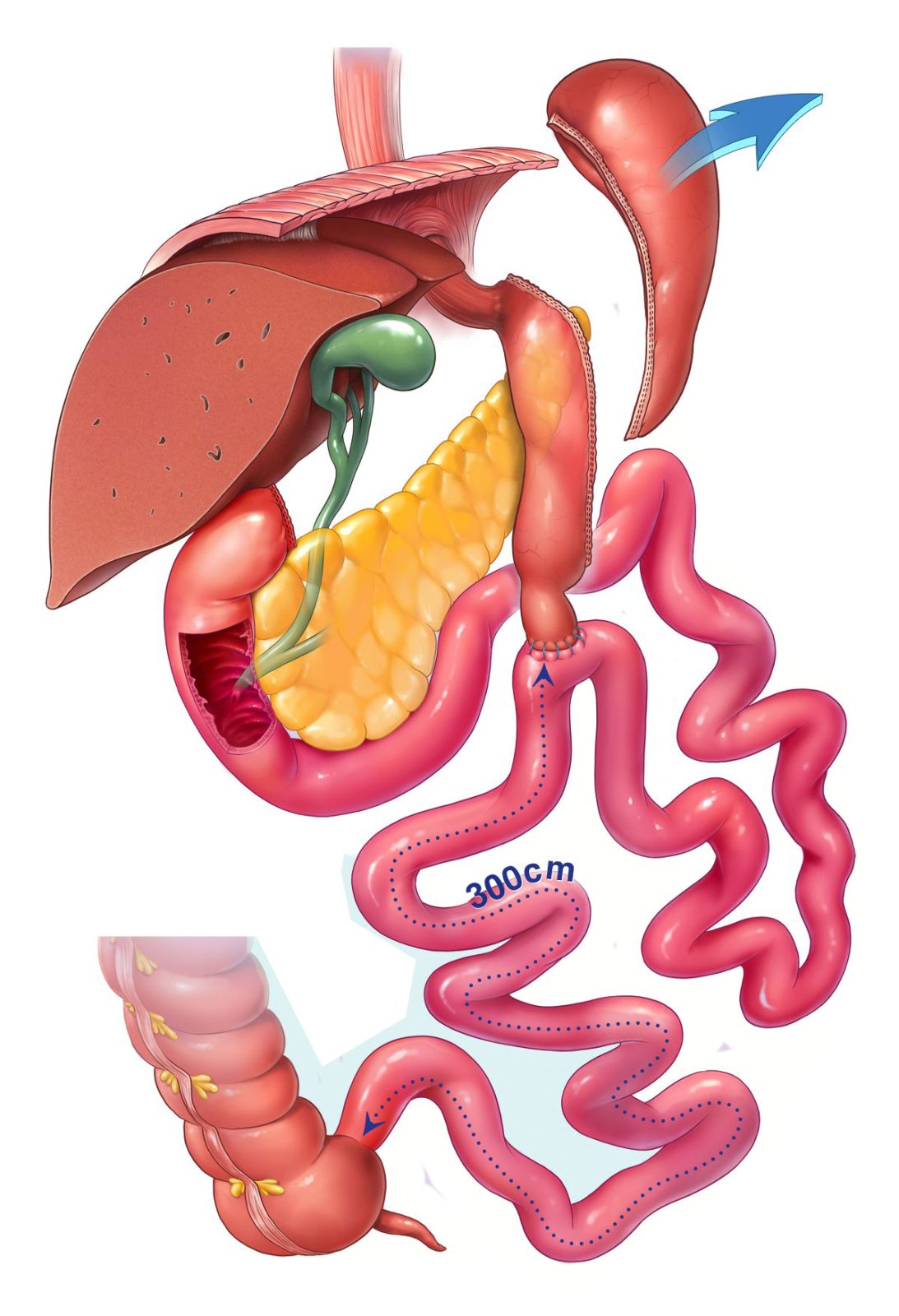 SIPS Surgery (SADI-S Surgery) | Perth Weight Loss & Surgery